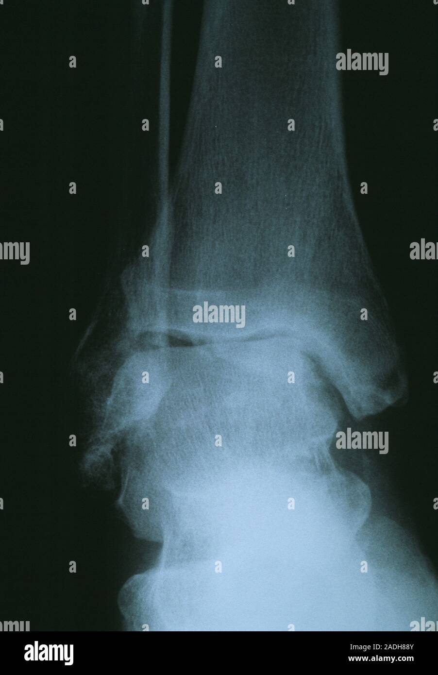 Osteoarthritis. X-ray (rear view) of the ankle of a 65-year-old woman ...