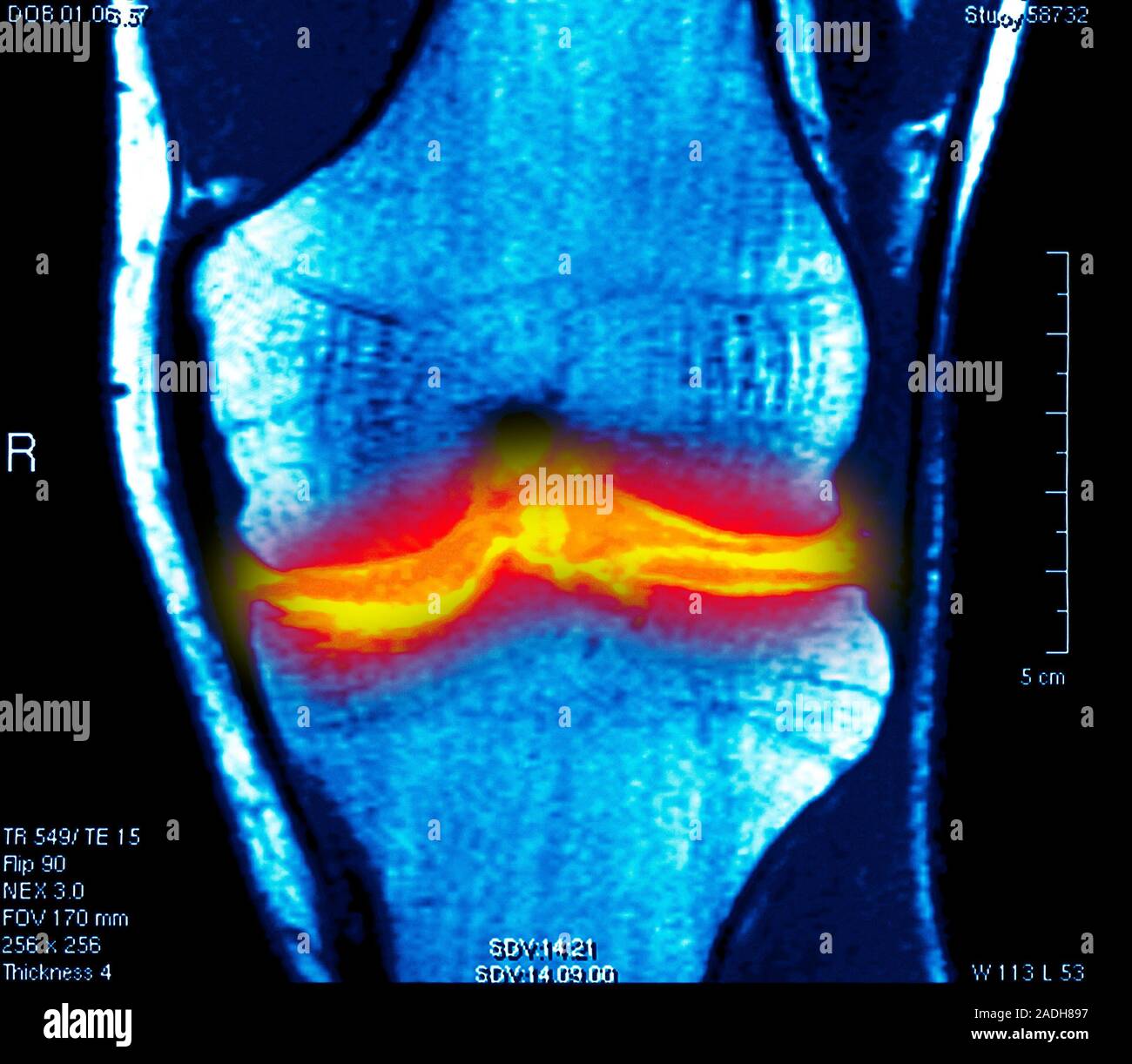 Joint disease. Coloured computed tomography (CT) scan of a knee ...