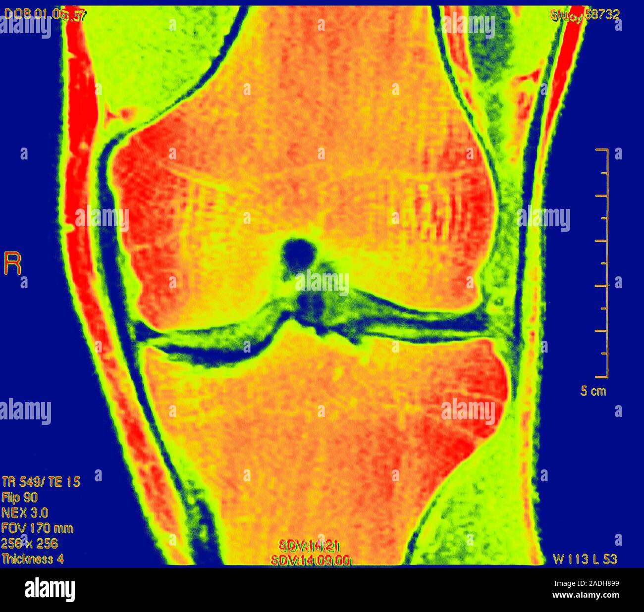 Joint disease. Coloured computed tomography (CT) scan of a knee ...