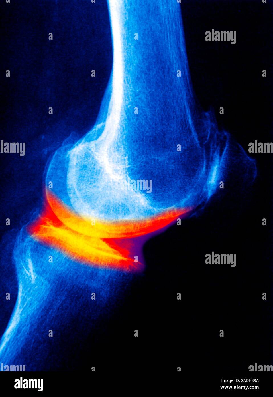 Joint disease. Coloured X-ray of a knee affected by arthrosis (yellow ...