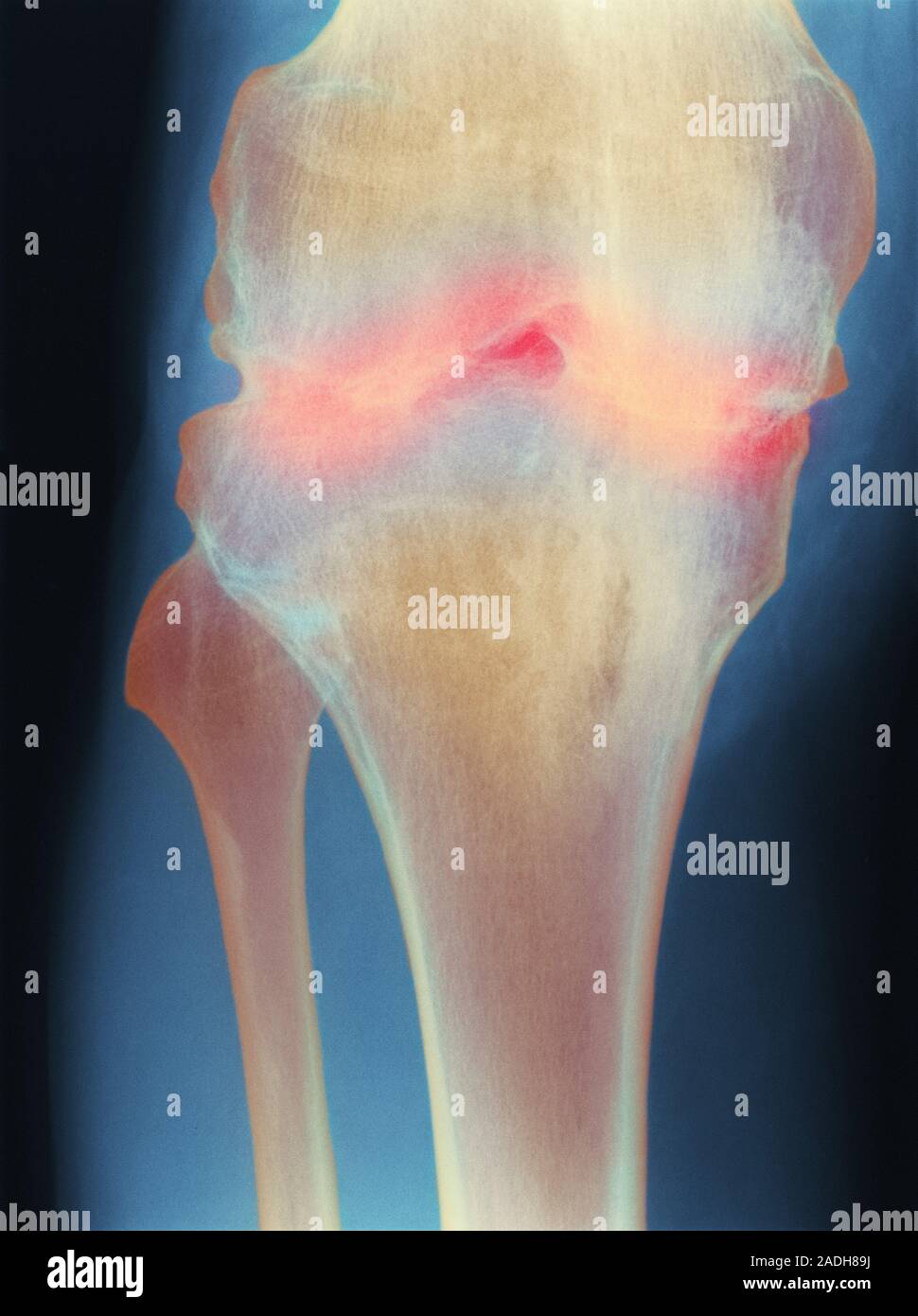 Fused knee joint. Coloured X-ray of a knee joint showing fusion of the ...
