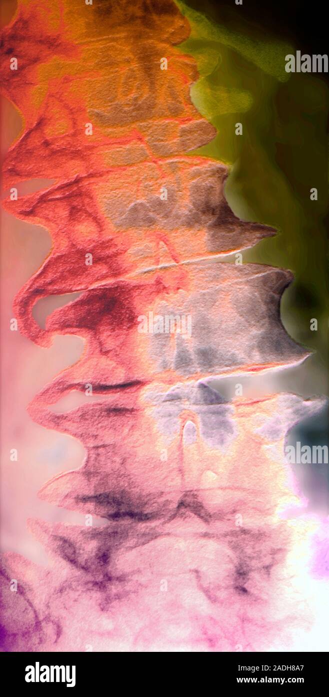 Diseased spine. Coloured X-ray of the dorso- lumbar region of the spine ...