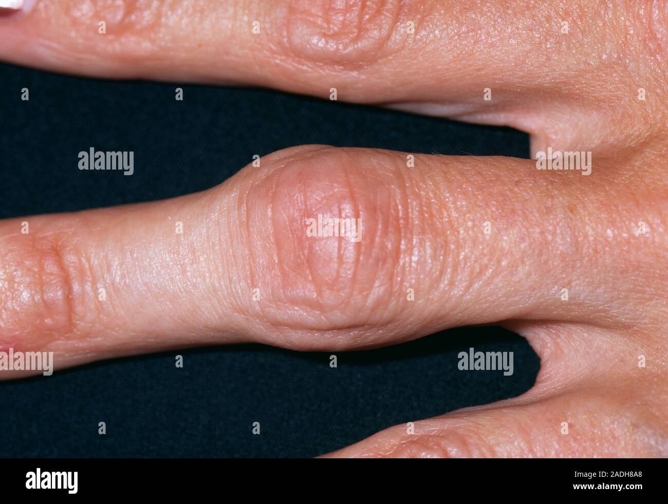 Arthritic finger. Close-up of a finger joint of a 40-year-old female ...