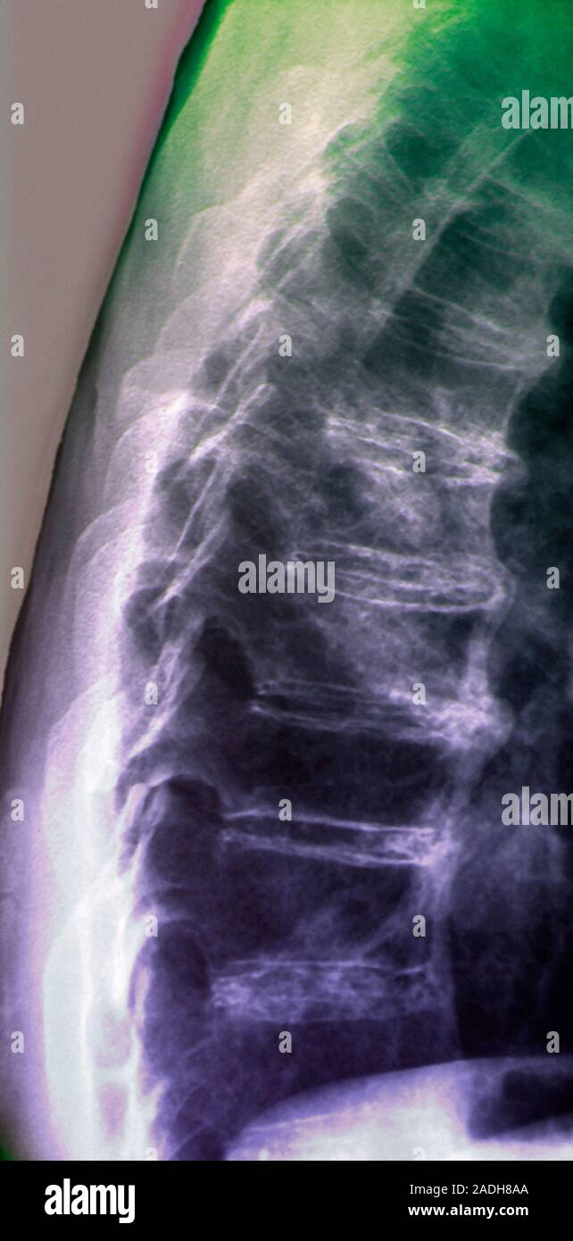 Ankylosing spondylitis. Coloured X-ray (side view) of the lumbar (lower ...
