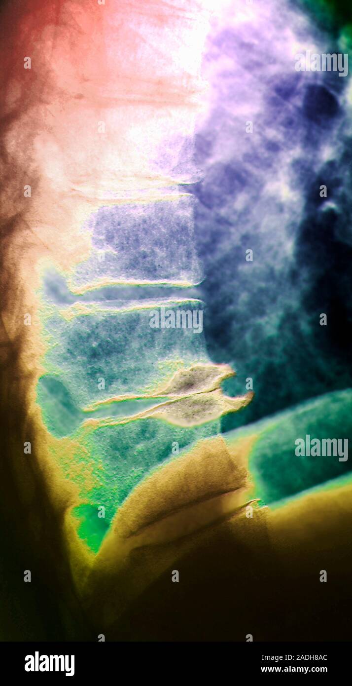 Diseased spine. Coloured X-ray of the thoracic spine of a patient with ...