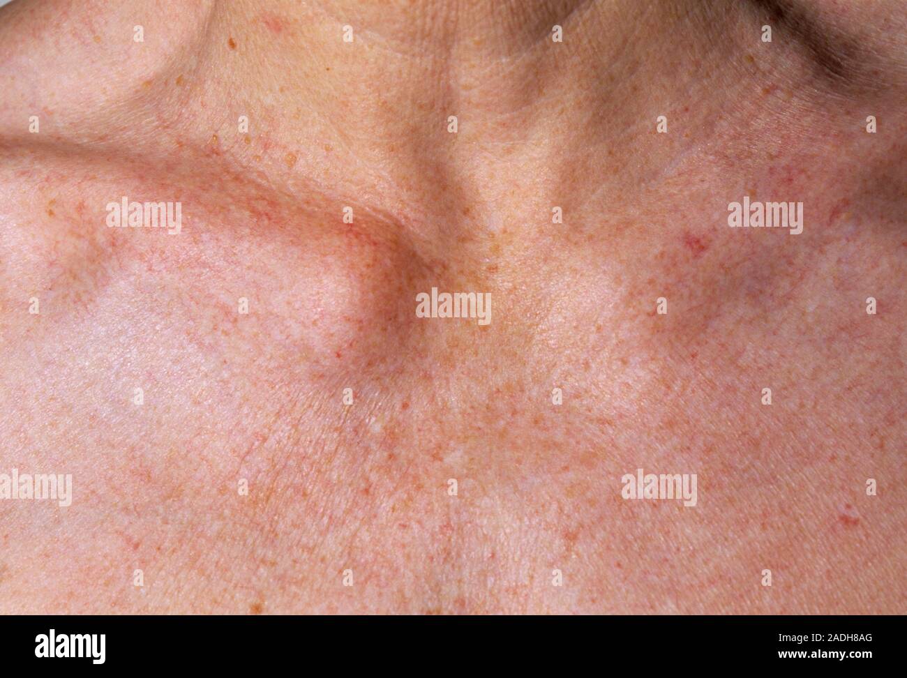 Arthritis affecting the joint between the sternum (breastbone) and the ...