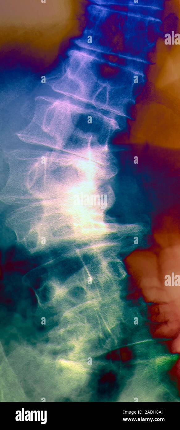 Diseased spine. Frontal coloured X-ray of the lumbar spine of a 48 year ...