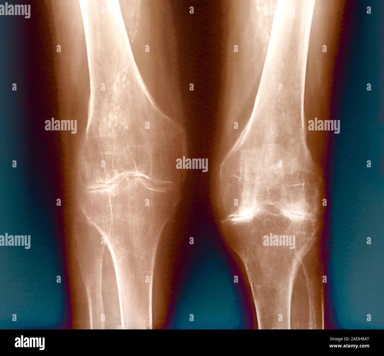 Arthritic knees. Coloured X-ray of the knees of a 59 year old with ...