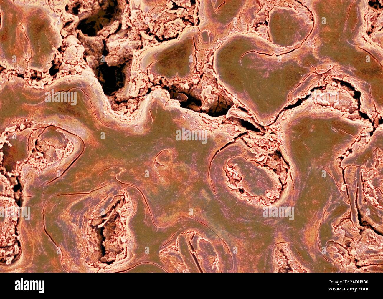 Damaged cartilage. Coloured scanning electron micrograph (SEM) of the damaged head of a femur ...
