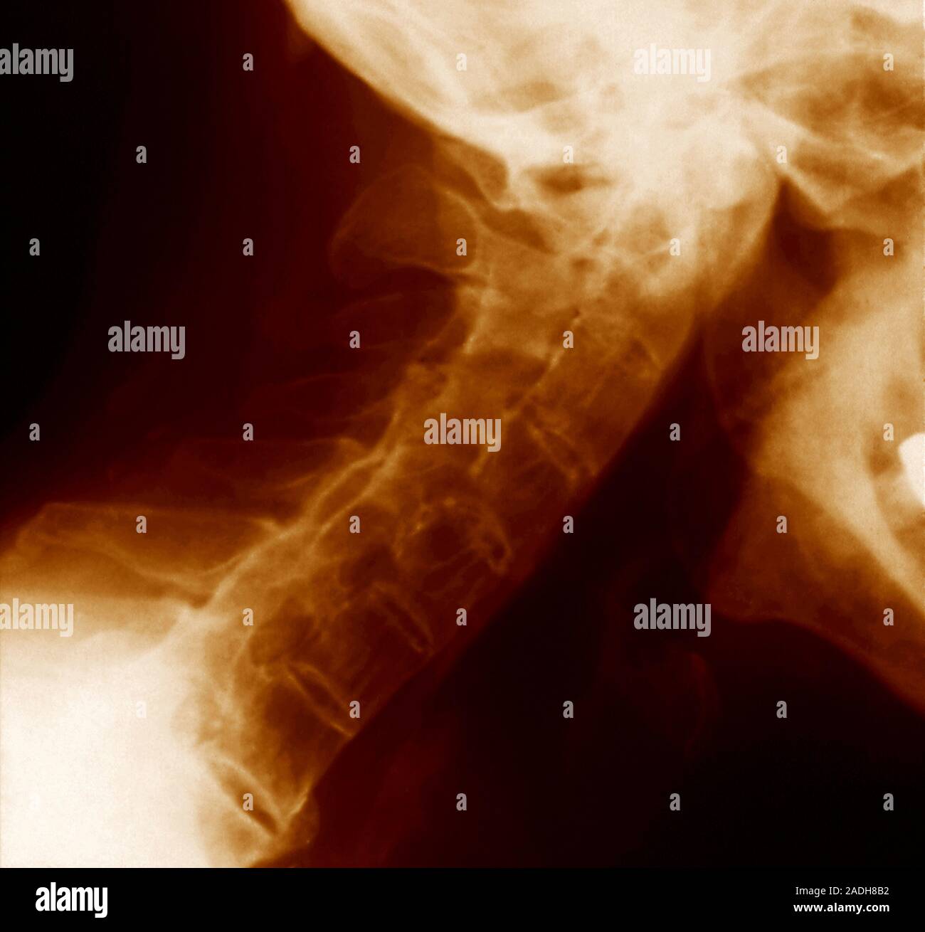 Ankylosing spondylitis. Coloured X-ray of a side- view of the cervical ...