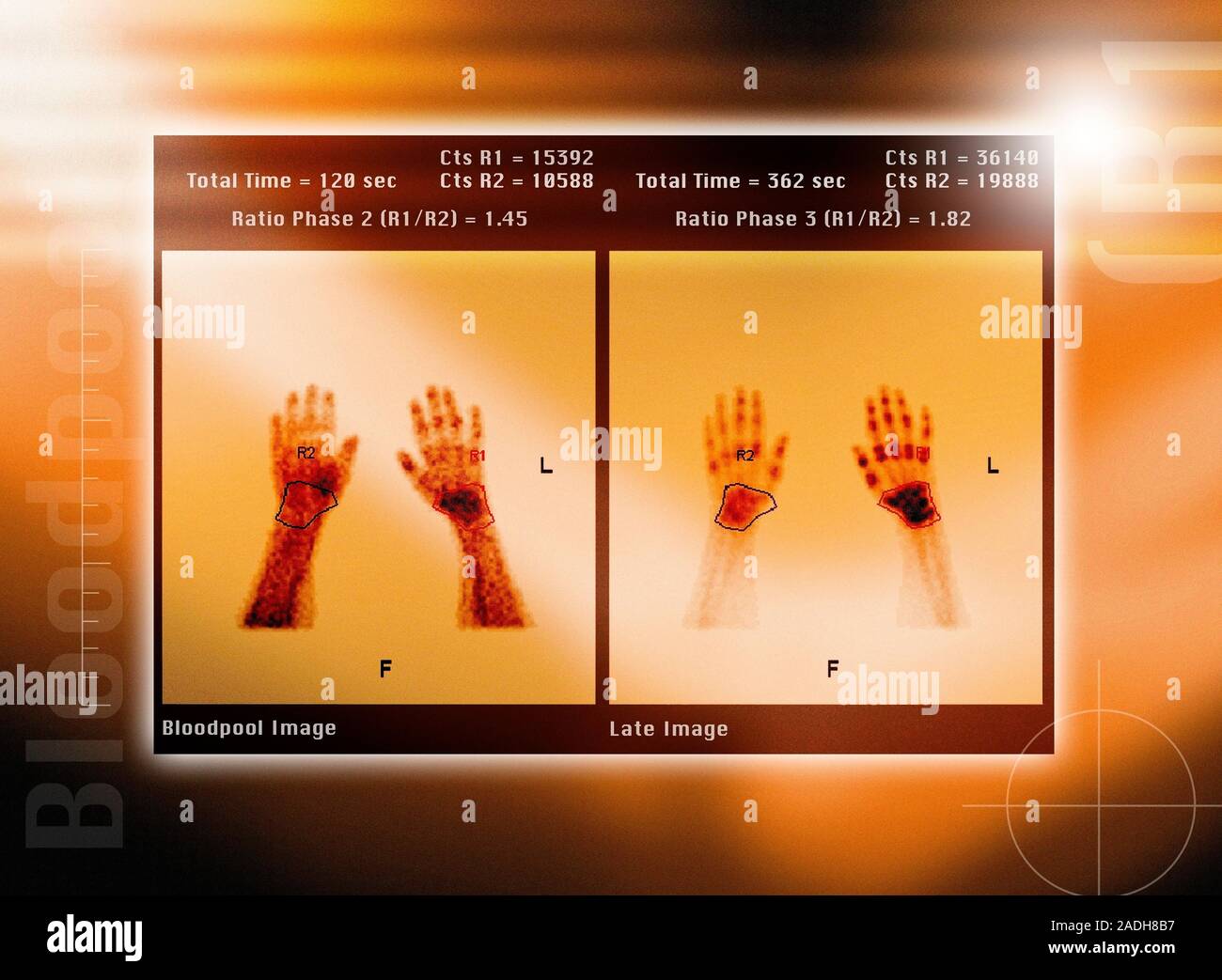 Arthritic hands, coloured gamma camera scan (scintigram). The hand most ...