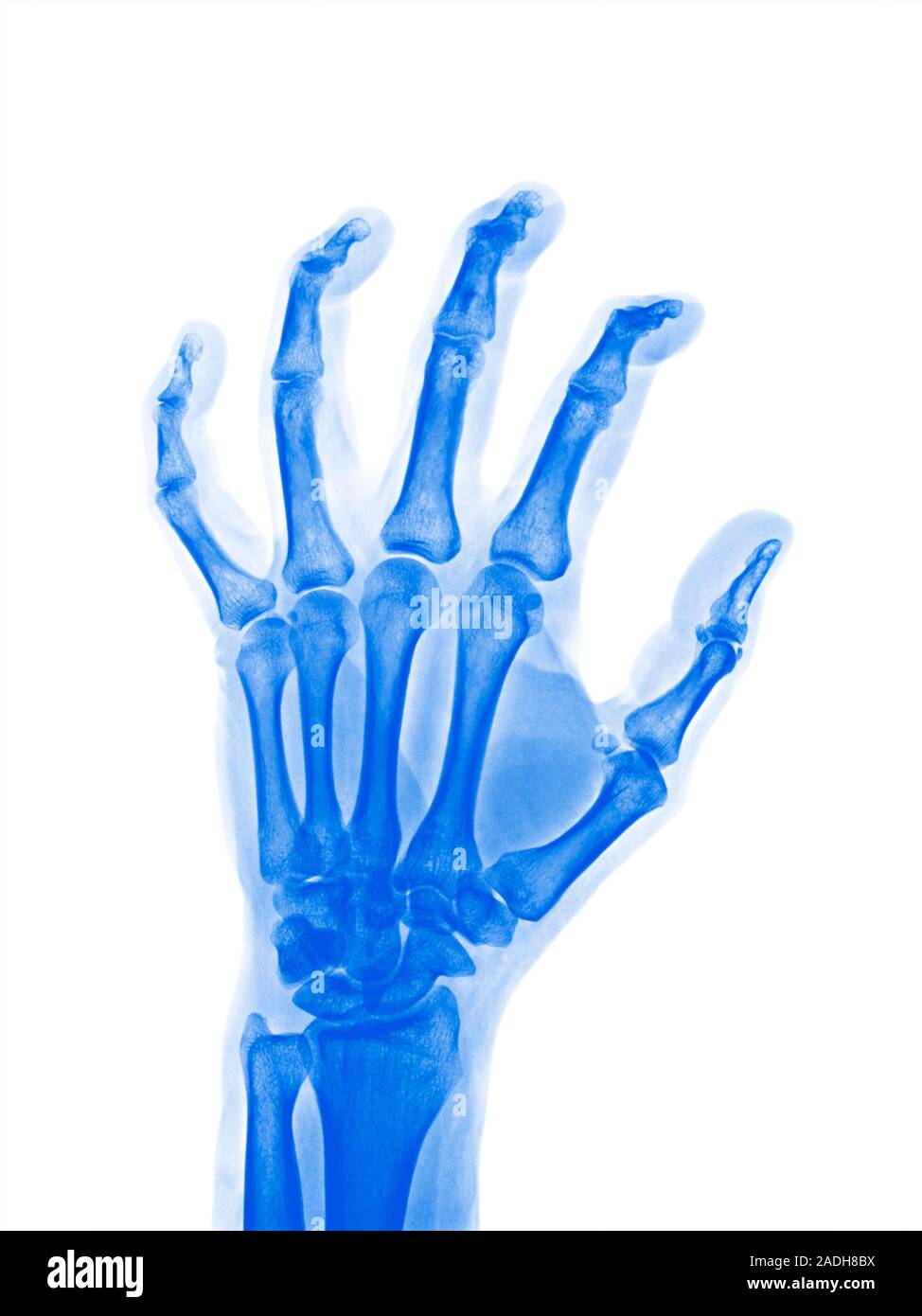 Arthritic hand. Computer-enhanced X-ray of the hand of a patient with ...