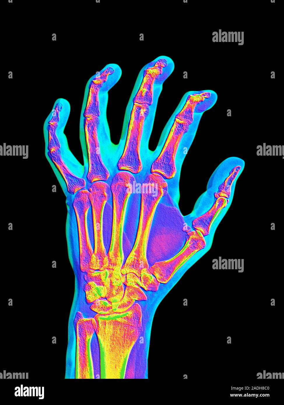 Arthritic hand. Computer-enhanced X-ray of the hand of a patient with ...