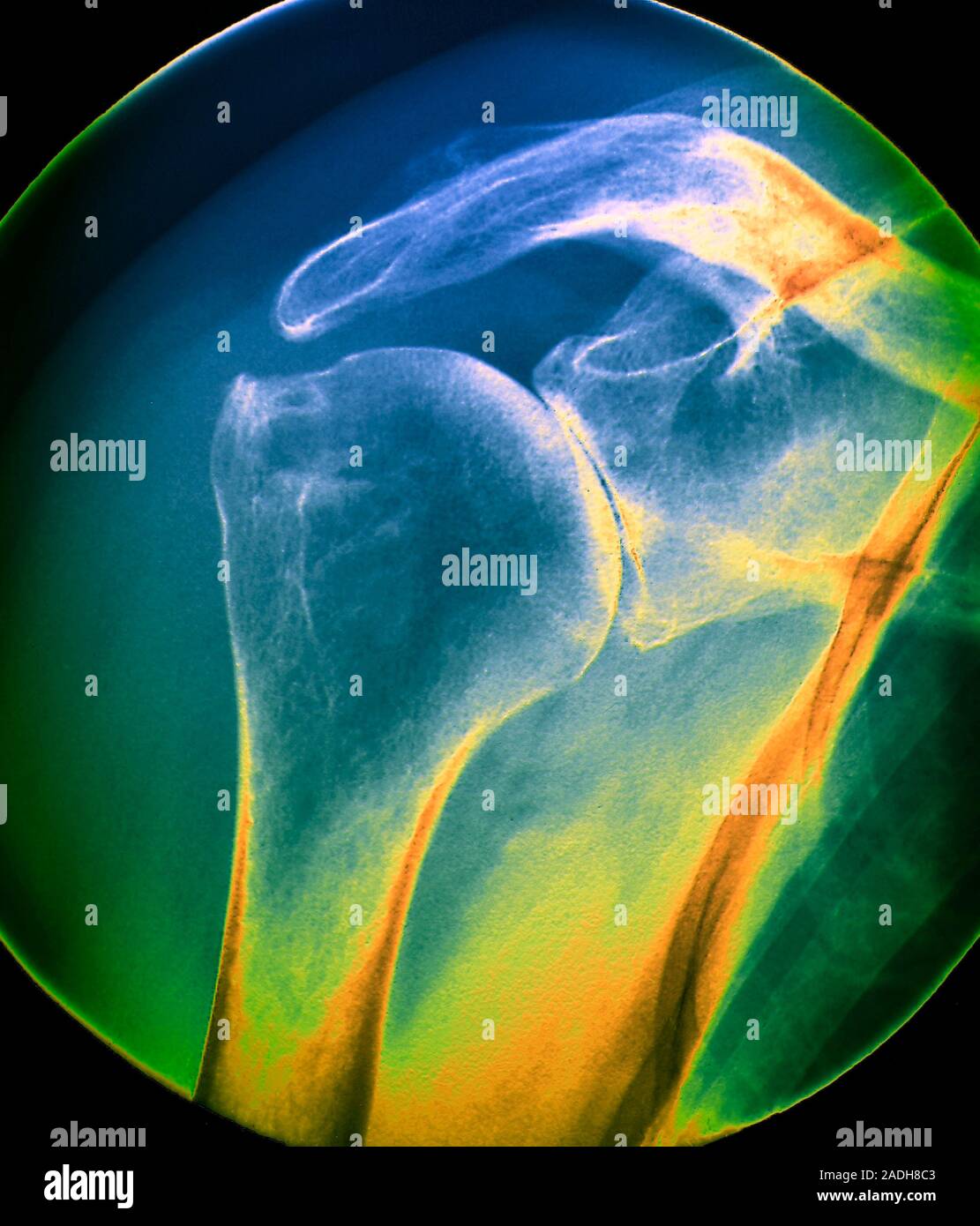 Arthritic shoulder. Coloured X-ray of the shoulder of a 68 year old ...