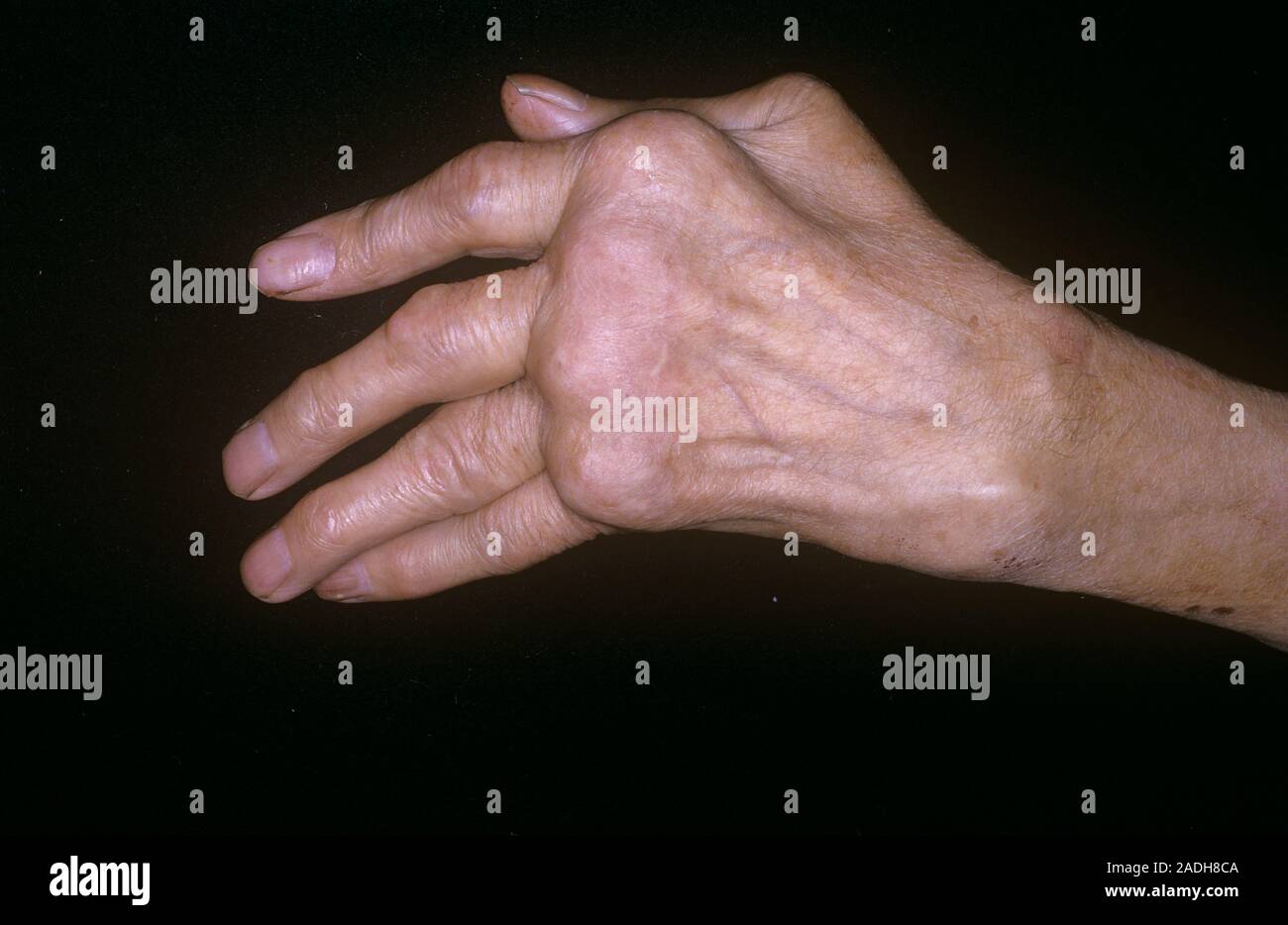 Arthritic hand. Hand of a patient with rheumatoid arthritis. The ...
