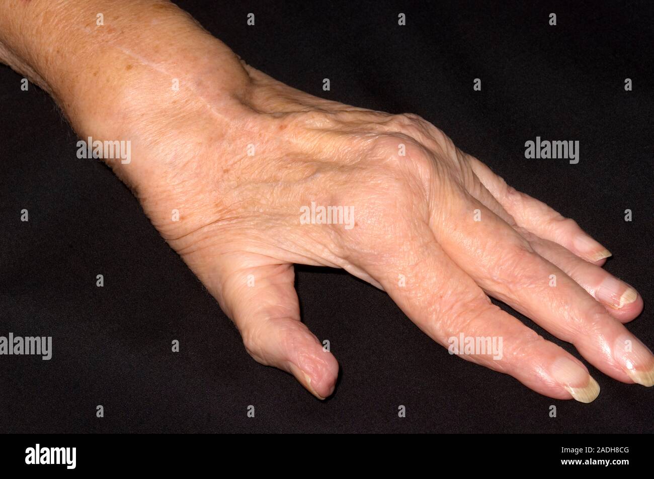 Rheumatoid arthritis affecting a 68-year-old woman's hand. Rheumatoid ...