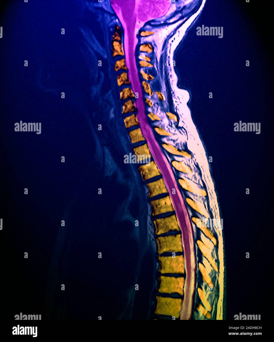 Arthritis of the spine. Coloured profile magnetic resonance imaging ...