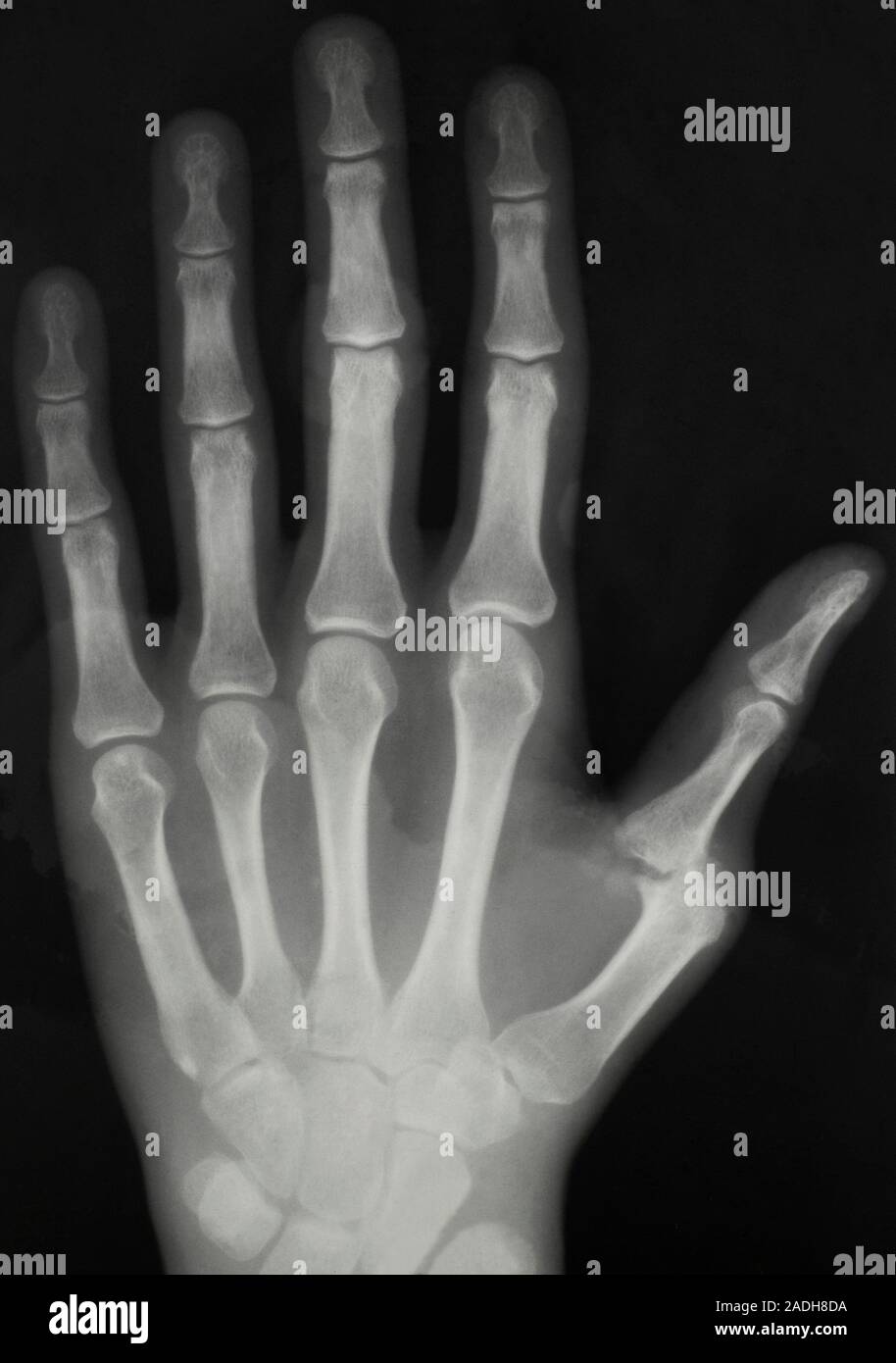 Arthritic hand. X-ray of the hand of a patient with severe rheumatoid ...