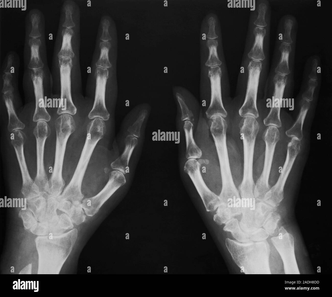 Arthritic hands. X-ray of the hands of a patient with severe rheumatoid ...
