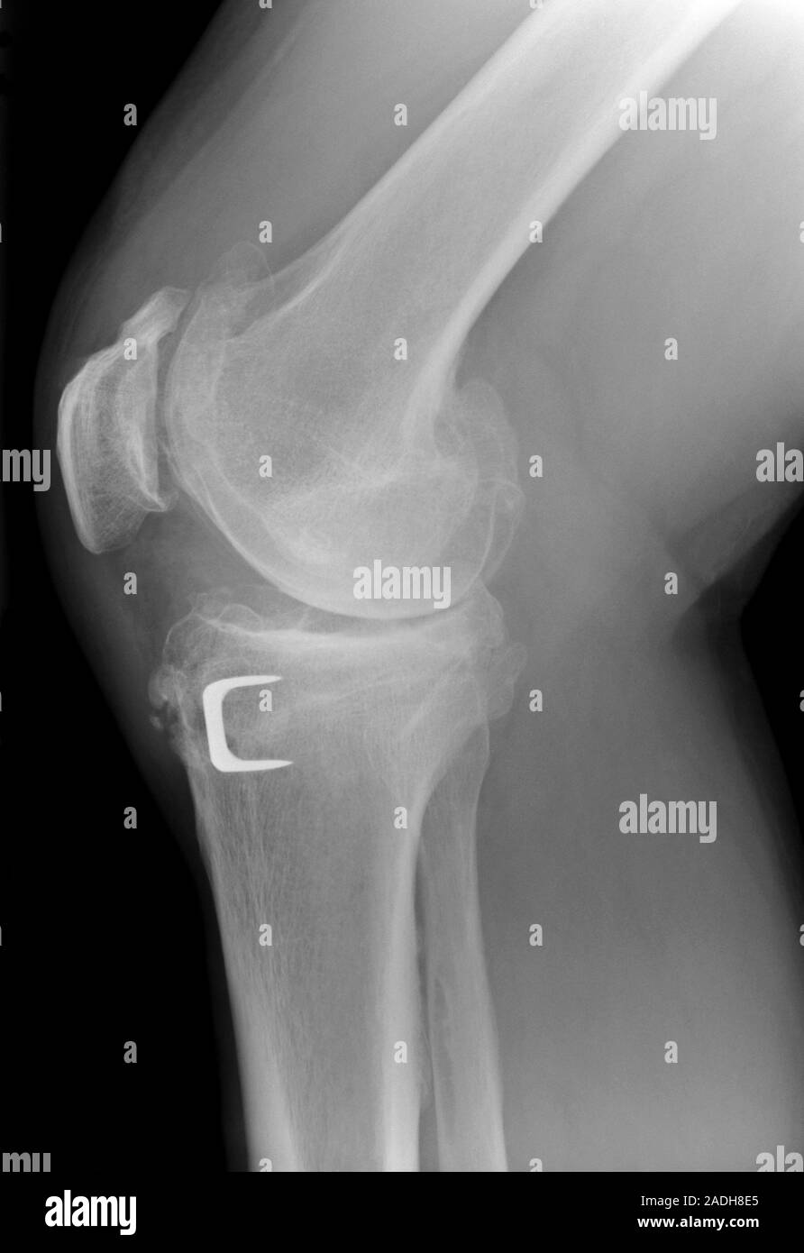 Osteoarthritis. X-ray of the knee of a 61-year-old man, showing signs ...
