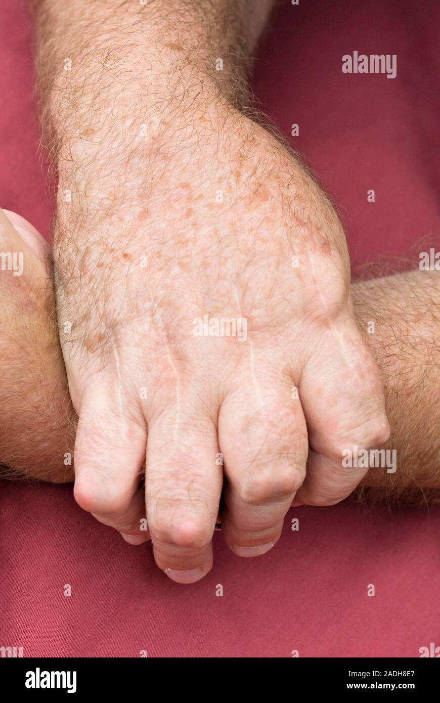 Rheumatoid arthritis affecting a man's hand. Rheumatoid arthritis is an ...