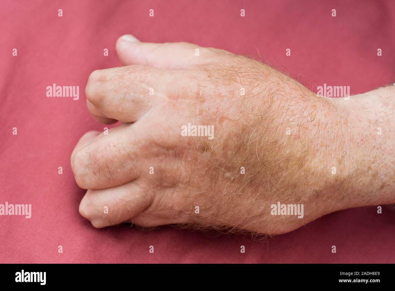Rheumatoid arthritis affecting a man's hand. Rheumatoid arthritis is an ...