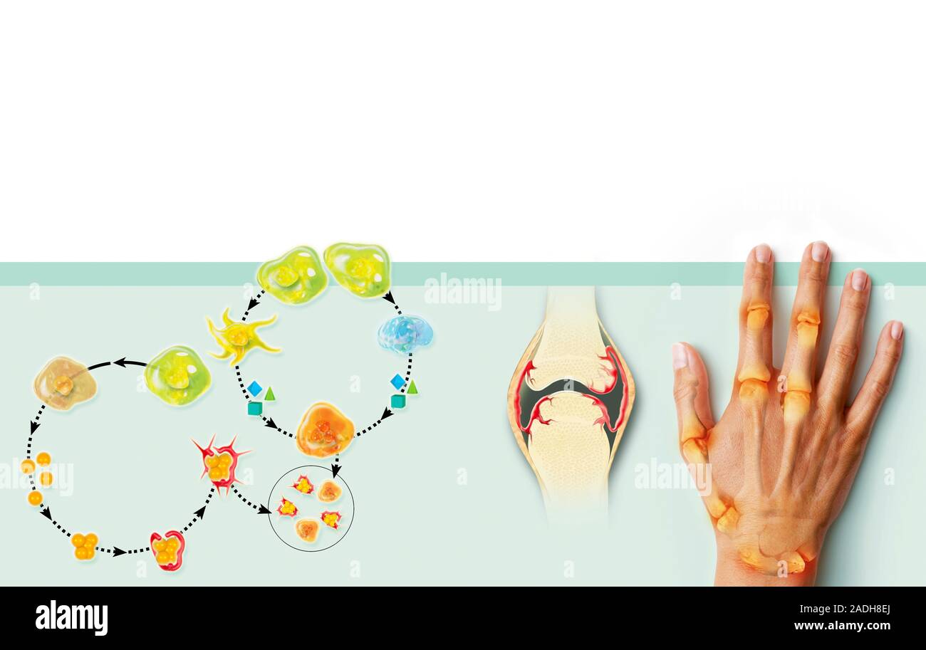 Rheumatoid arthritis mechanism. Artwork showing various aspects of ...