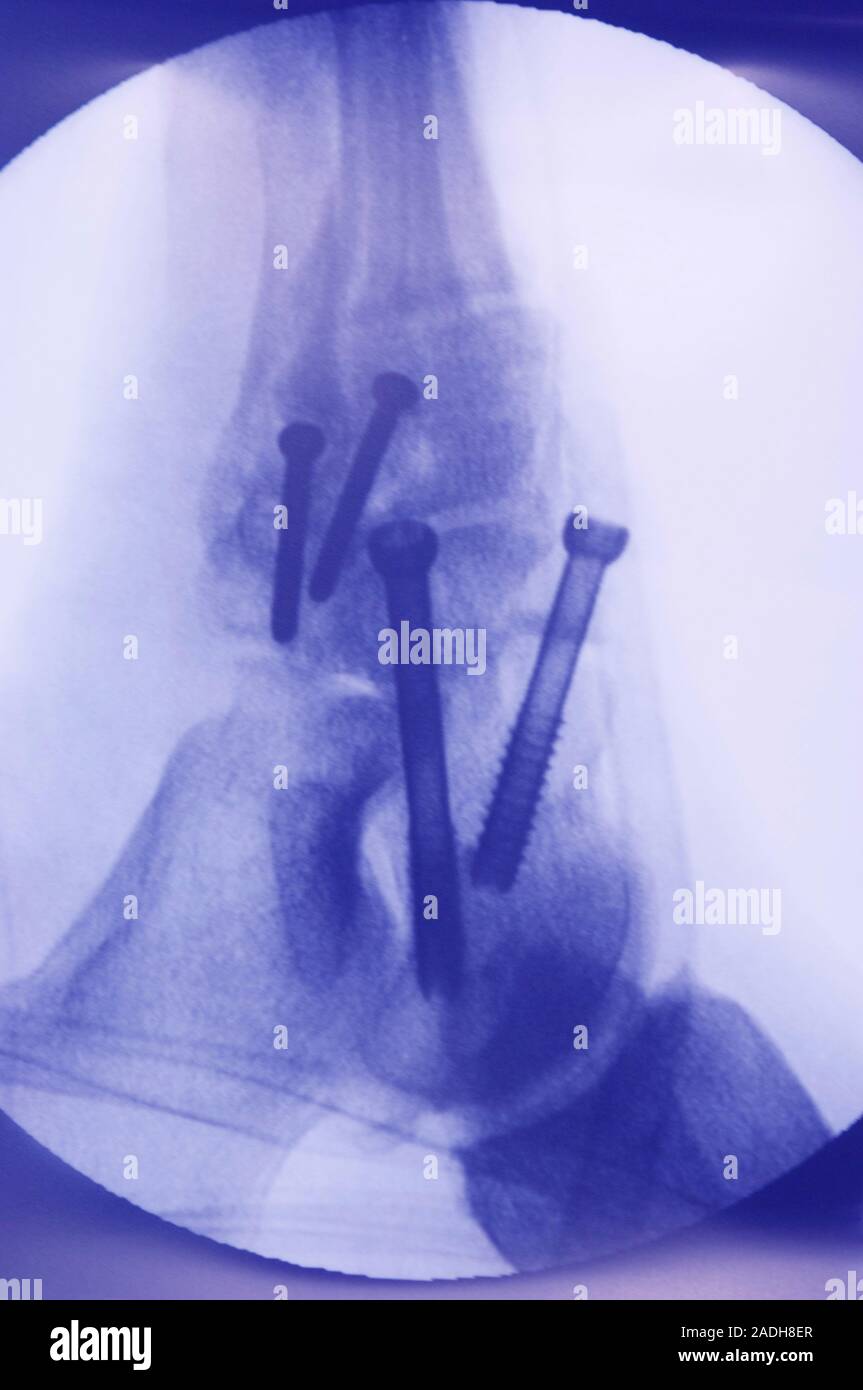Pinned ankle. Coloured X-ray of the ankle bones of a patient that has ...