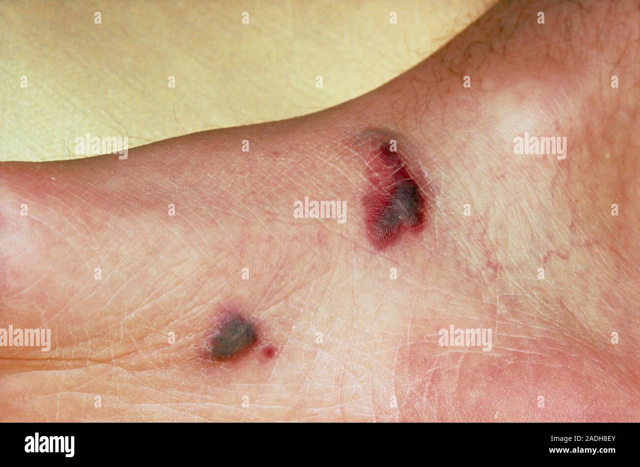 Photograph of the foot of the foot of a person suffering from AIDS ...
