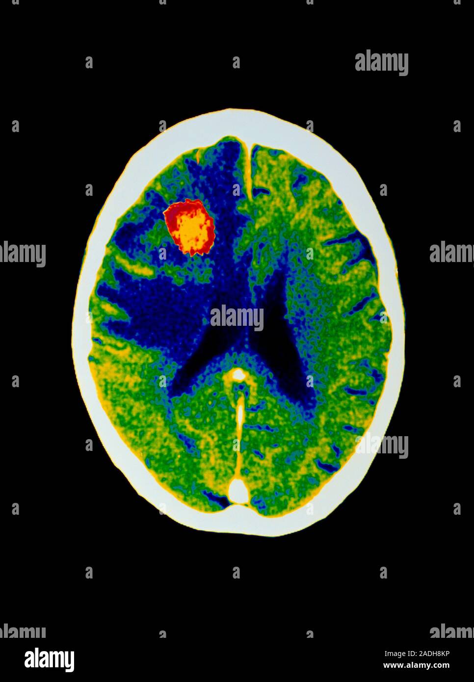Brain abscess in AIDS. Coloured computed tomography (CT) scan of an axial section through the ...