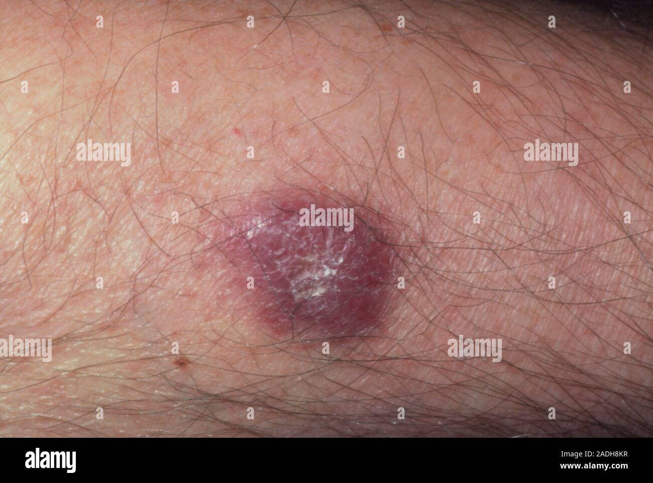 Kaposi's sarcoma. Close-up of a Kaposi's sarcoma lesion on the skin of ...