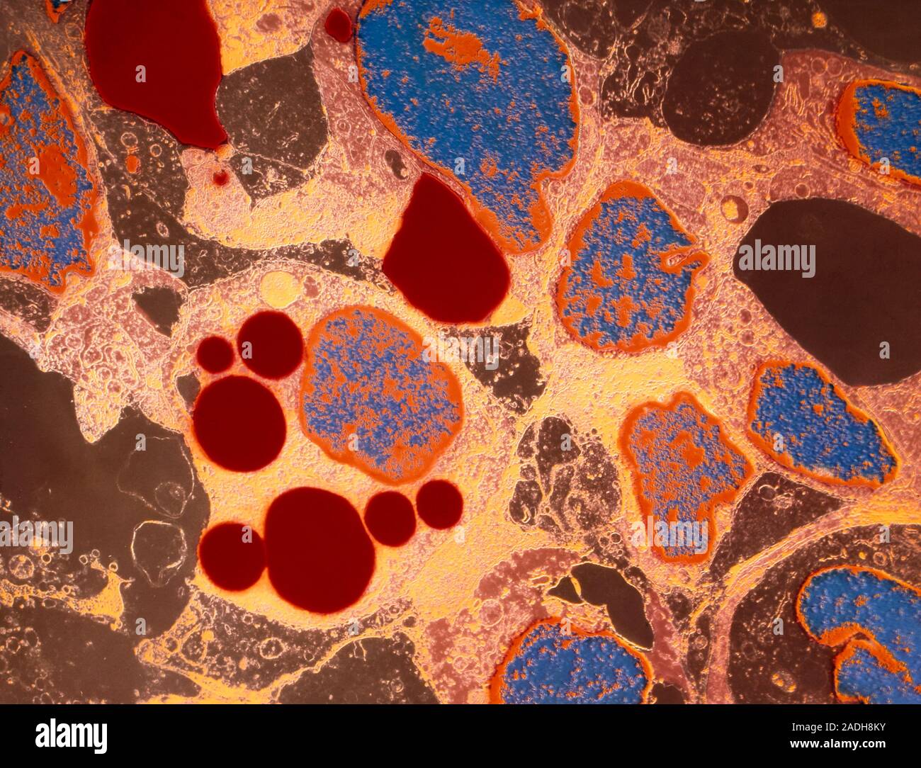 Kaposi's sarcoma. Coloured transmission electron micrograph (TEM) of ... Kaposi's sarcoma. Coloured transmission electron micrograph (TEM) of ...