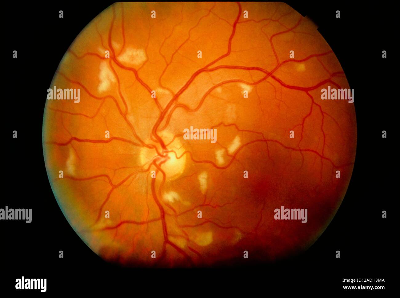 CMV retinitis in AIDS. Ophthalmoscope view of the retina of an AIDS ...