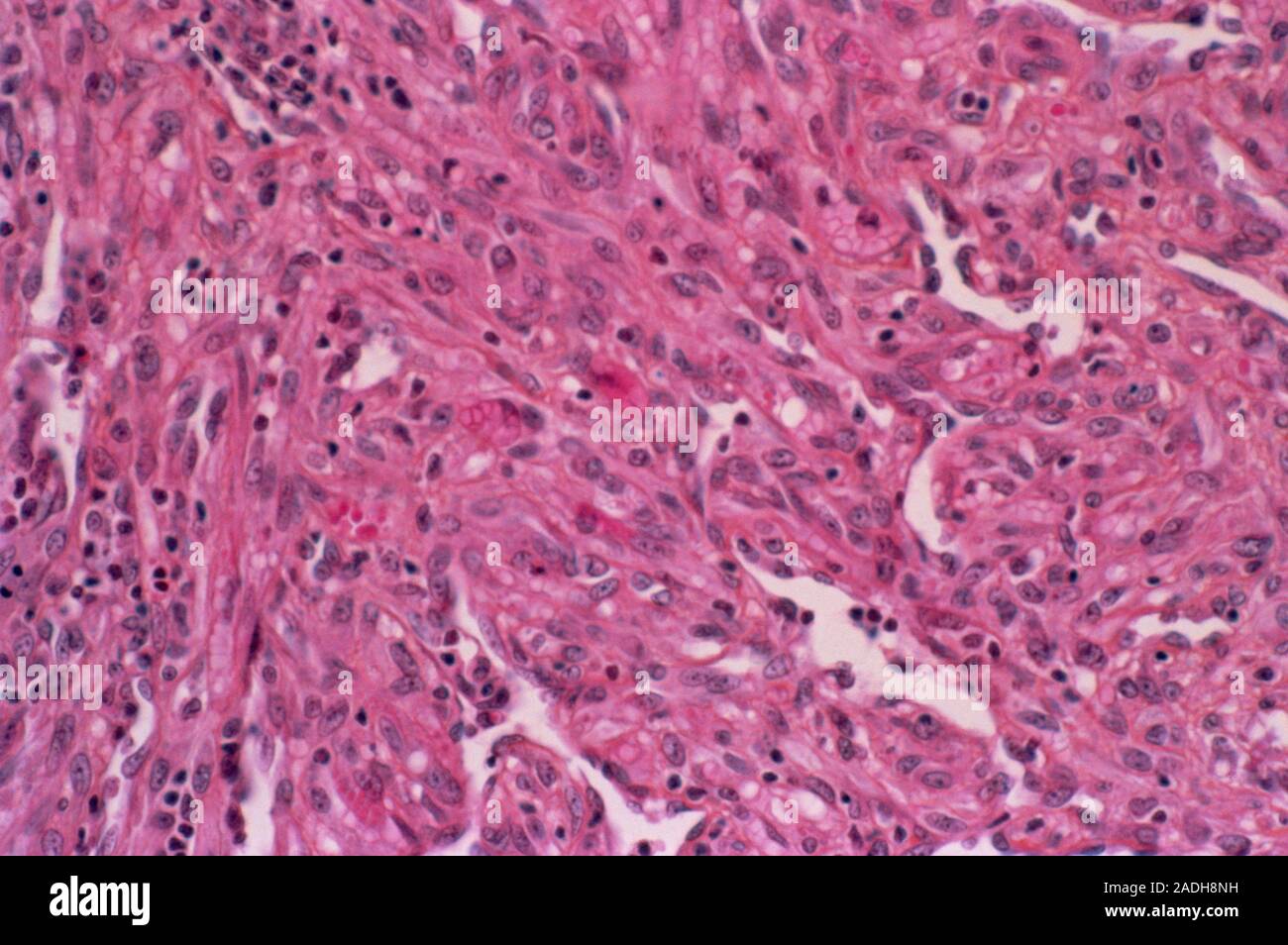 Kaposi's sarcoma. Light micrograph of a section through a Kaposi's ... Kaposi's sarcoma. Light micrograph of a section through a Kaposi's ...