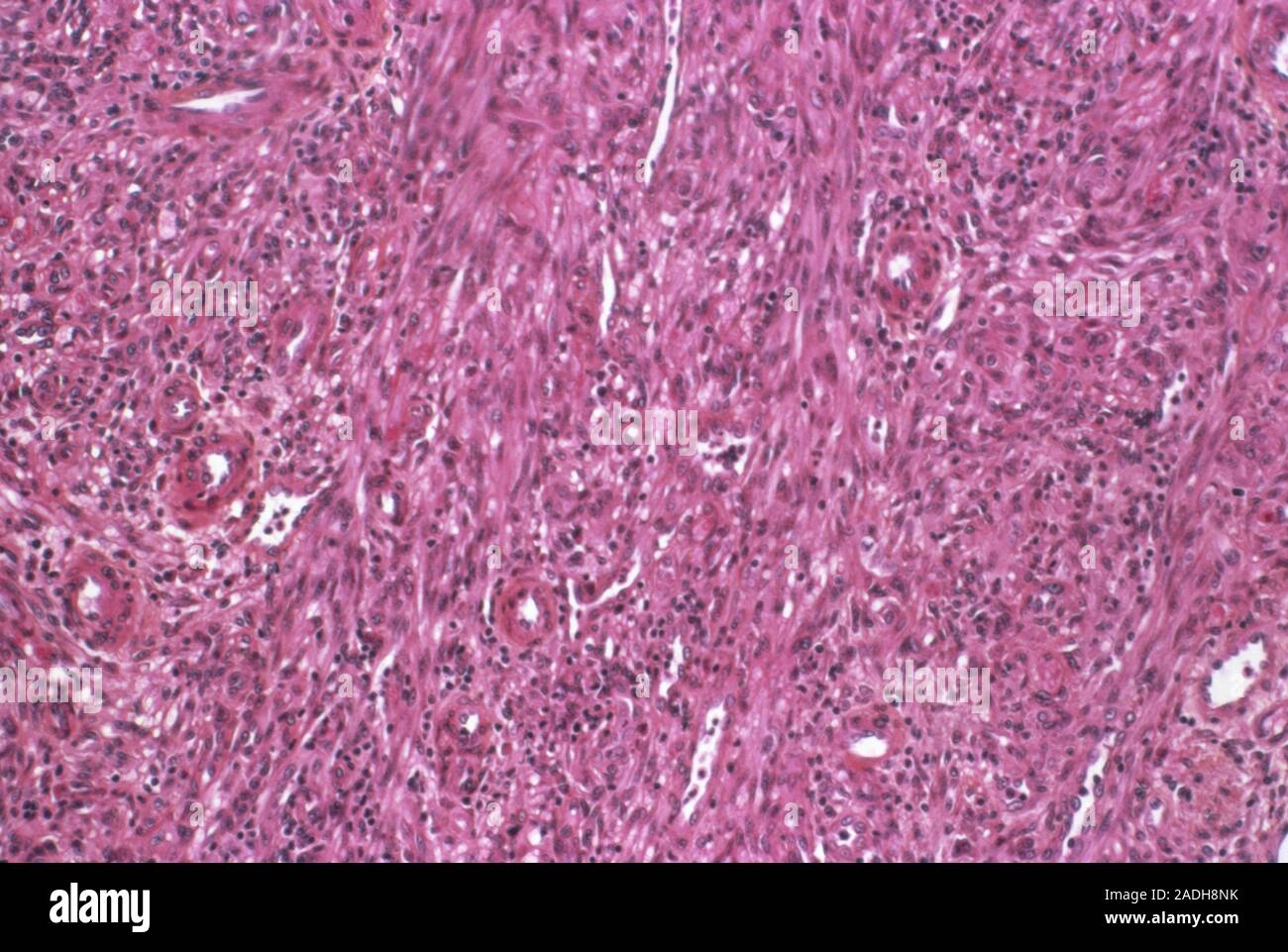 Skin cancer. Light micrograph of a section through a Kaposi's sarcoma ... Skin cancer. Light micrograph of a section through a Kaposi's sarcoma ...