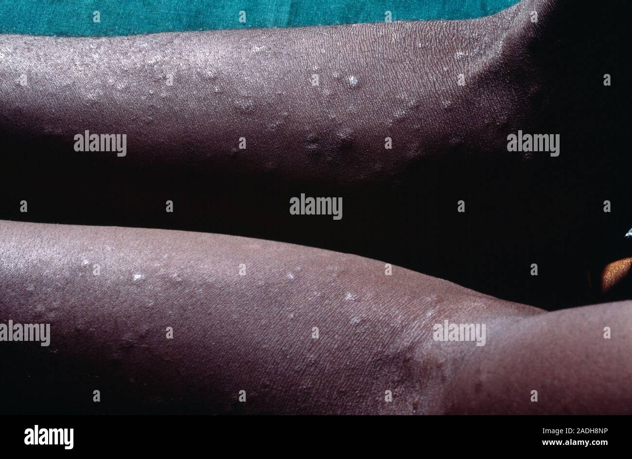 Syphilis rash in an AIDS patient. Scaly and lumpy syphilide (syphilis ...