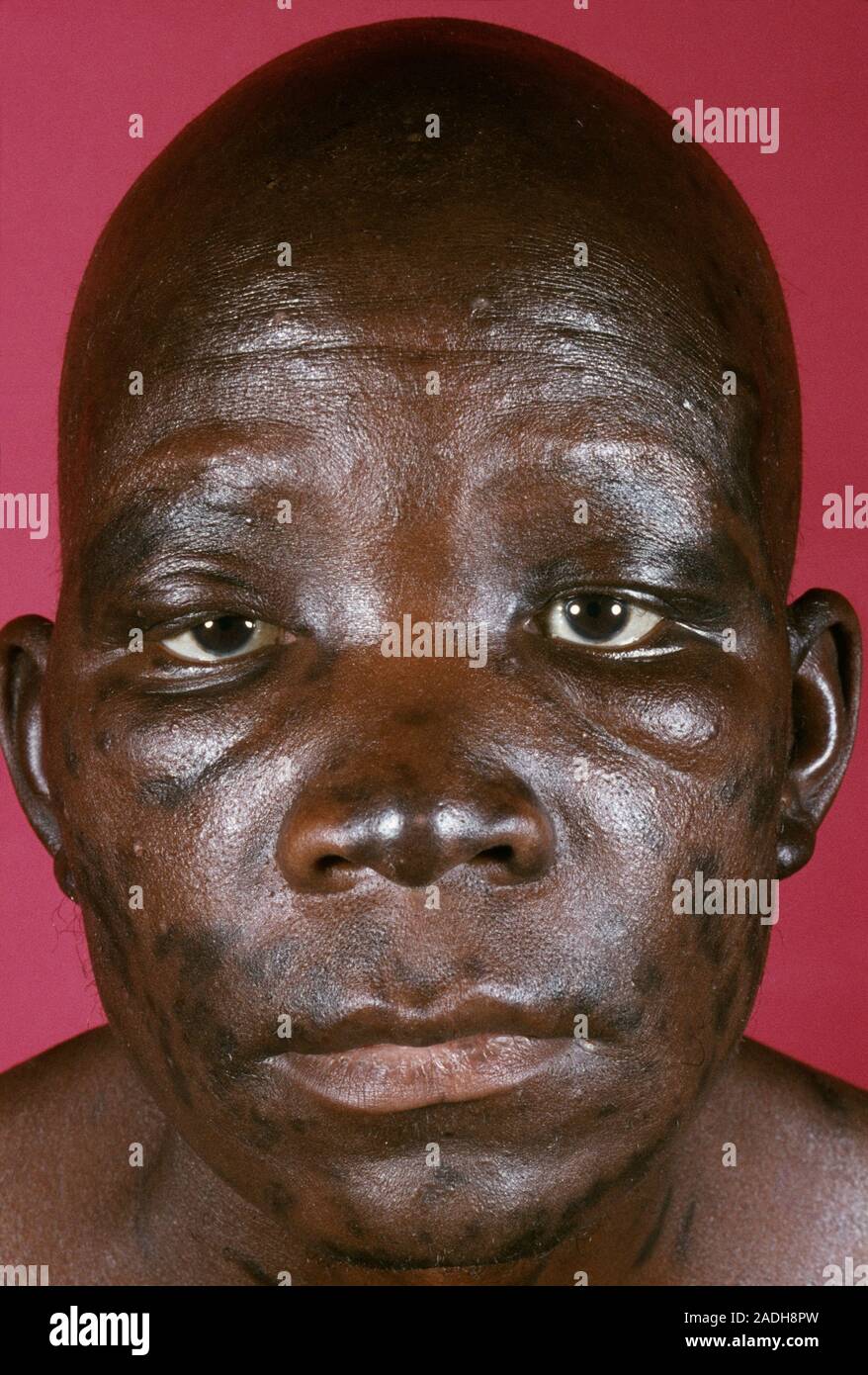 Kaposi's sarcoma. Image 2 of 2. Skin plaques on the face of a patient ...