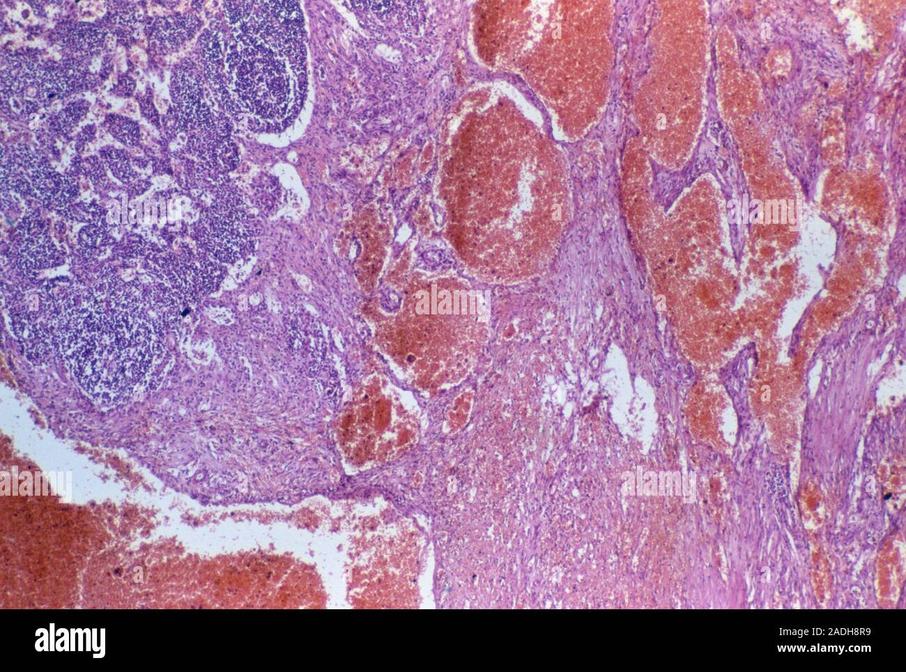 Kaposi's sarcoma. Light micrograph of a section through the capsule of ... Kaposi's sarcoma. Light micrograph of a section through the capsule of ...