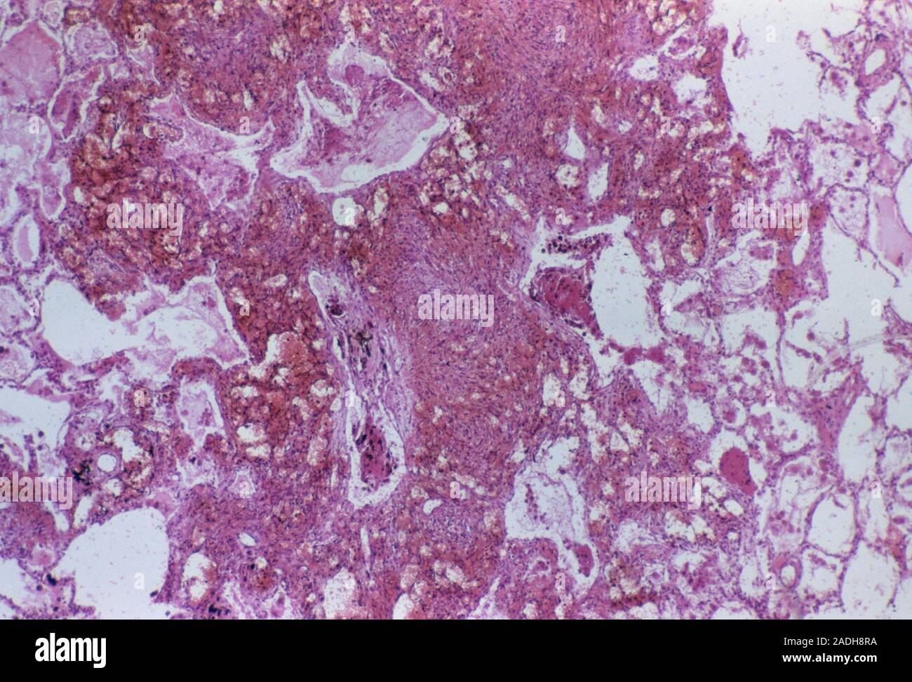 Kaposi's sarcoma. Light micrograph of a section through part of the ... Kaposi's sarcoma. Light micrograph of a section through part of the ...