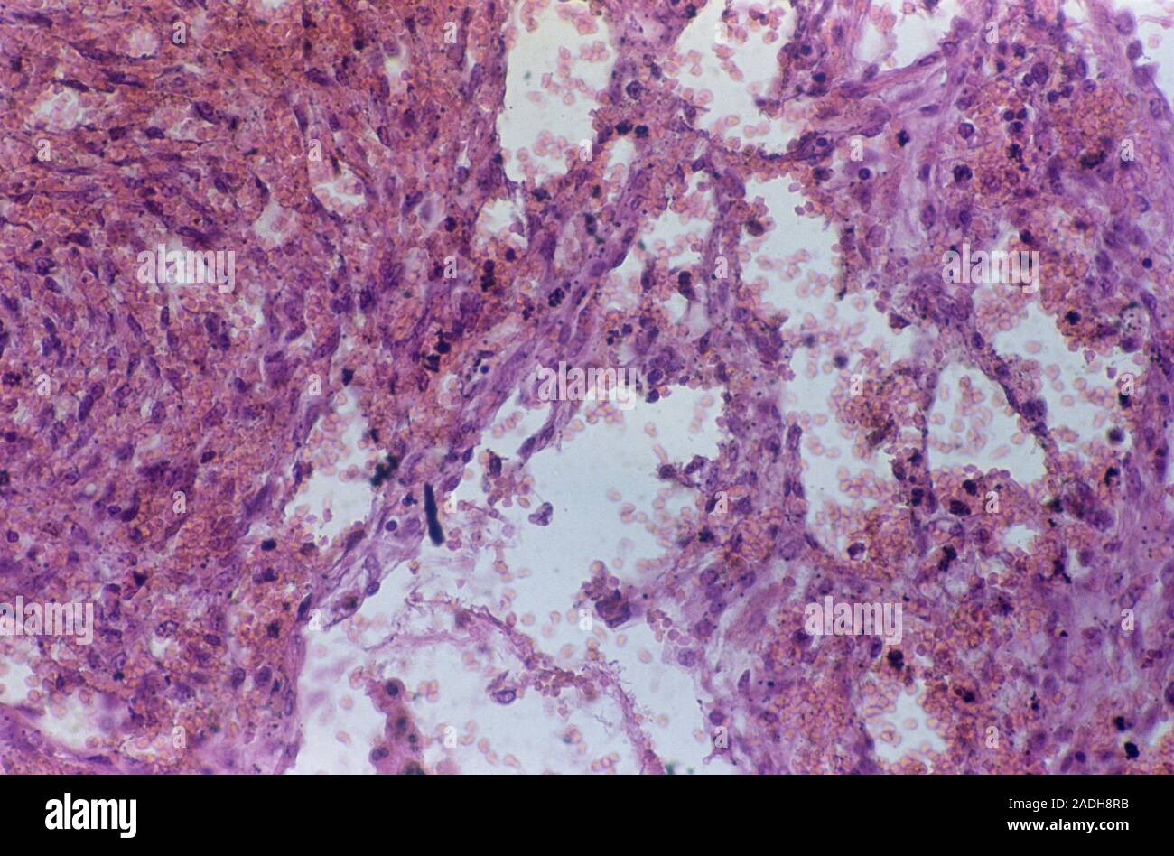 Kaposi's sarcoma. Light micrograph of a section through part of the ... Kaposi's sarcoma. Light micrograph of a section through part of the ...