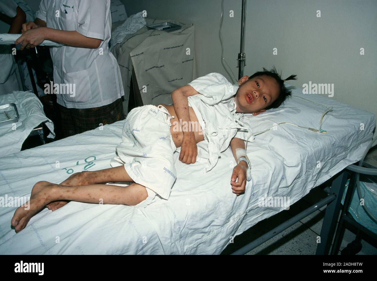 AIDS child. Girl with AIDS undergoing a lumbar puncture. This procedure ...
