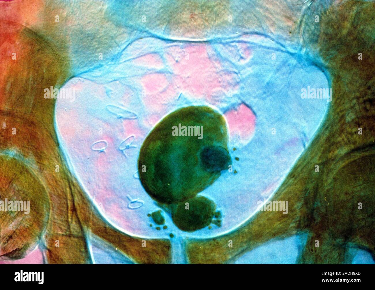 False-colour X-ray image of the human pelvis, showing mulitple, bulky ...
