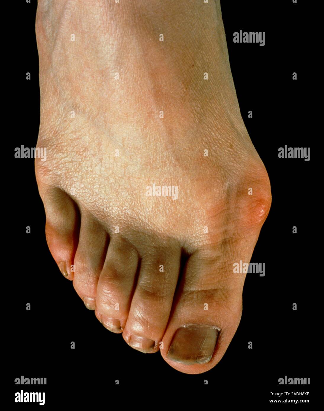 Bunion, a swelling of the joint between the big toe and the first ...