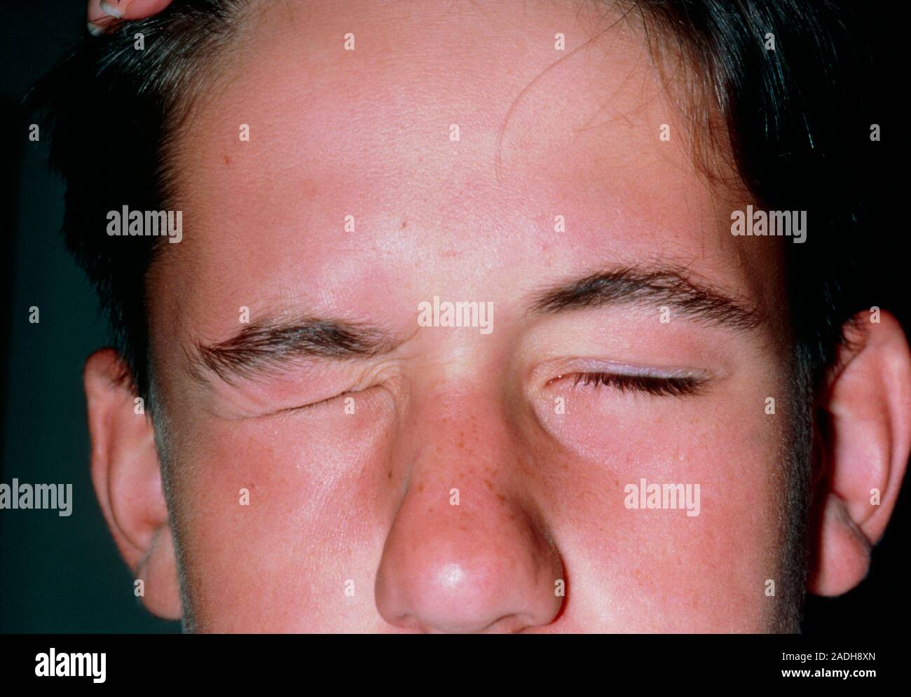 Teenage boy suffering from Bell's palsy, photographed during an ...