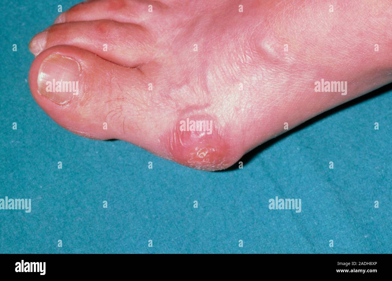 A bunion on a woman's right foot. A bunion is a swelling of the joint ...