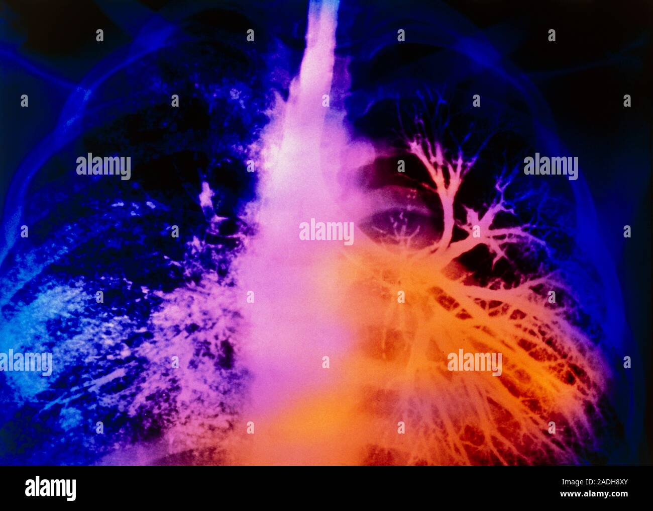 Bronchiectasis: false-colour bronchogram of the human lungs revealing ...