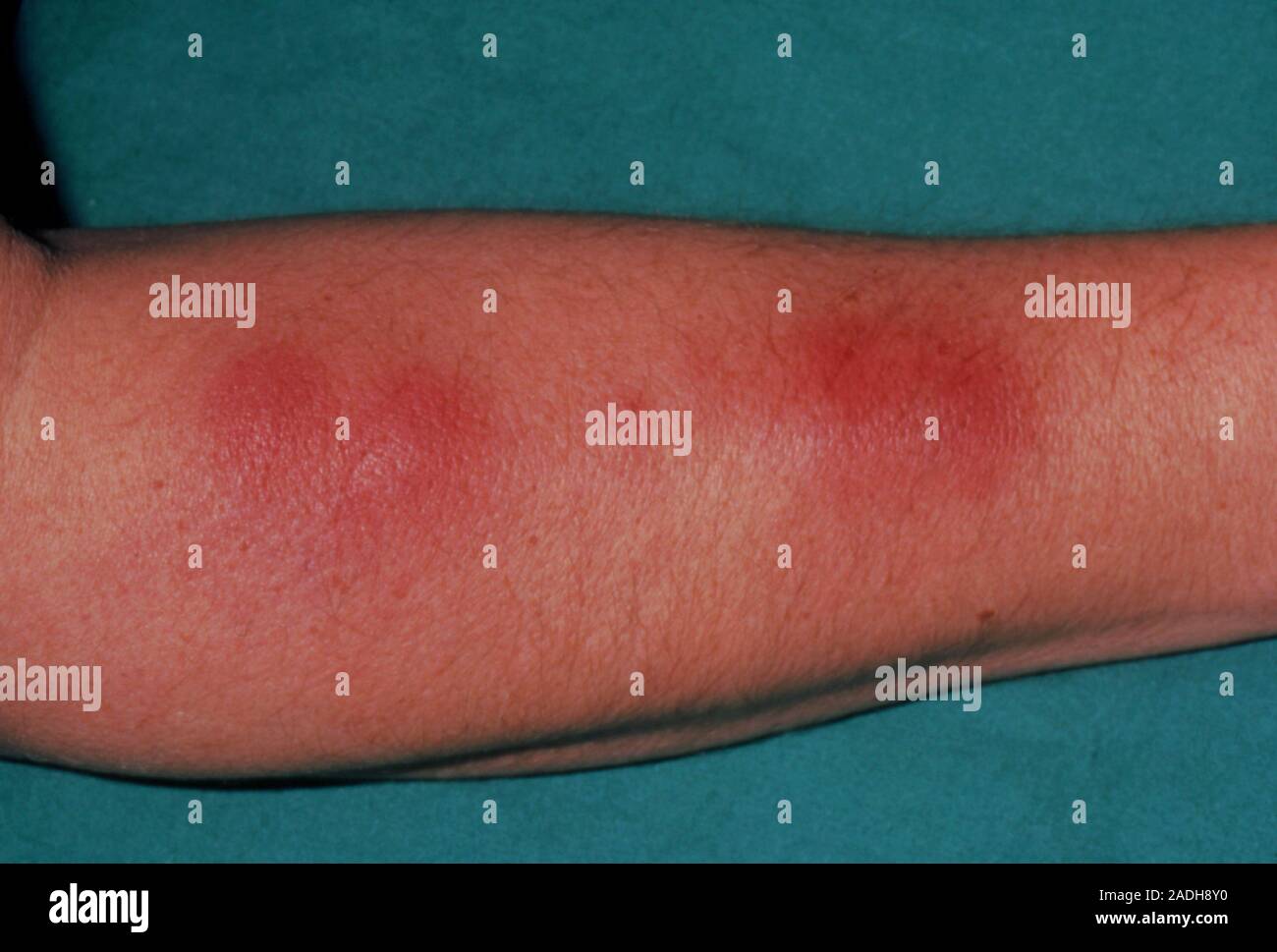 Boils. Close-up of the forearm of a patient, showing boils (furuncles ...