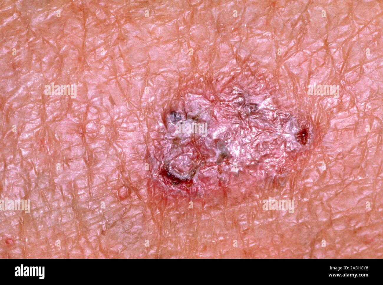 Bowen's disease. Close-up of a dark, bruise-like lesion on the leg of ...