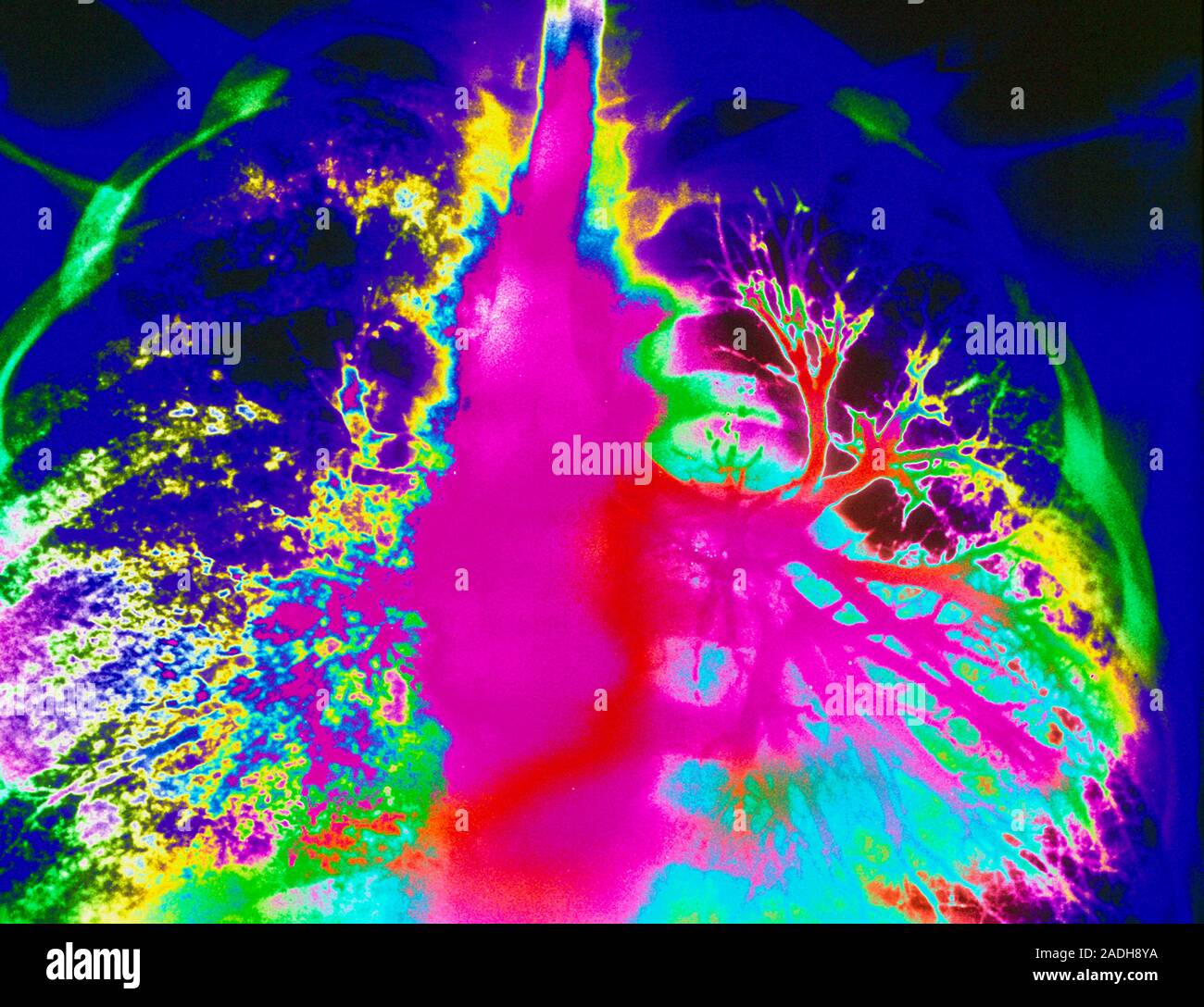 Bronchiectasis. Computer enhanced bronchogram X- ray of the human lungs ...