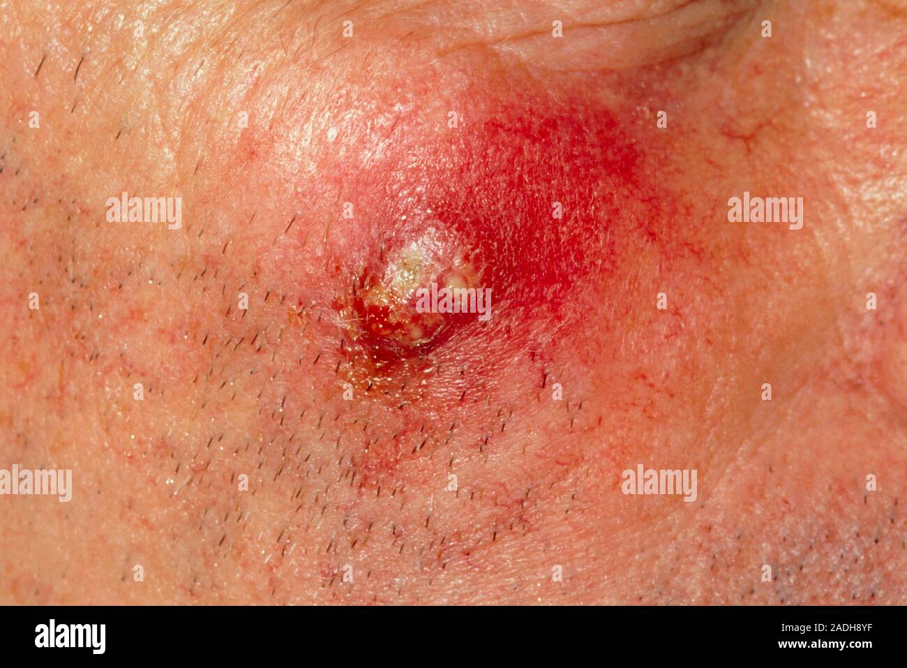 Boil on cheek. A red, inflamed and pus-filled boil (furuncle) seen on ...